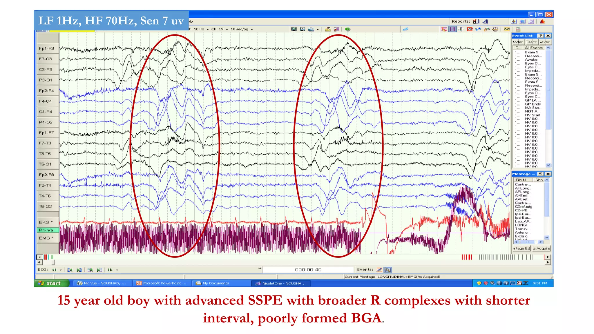 Generalised periodic epileptiform discharges | PPTX