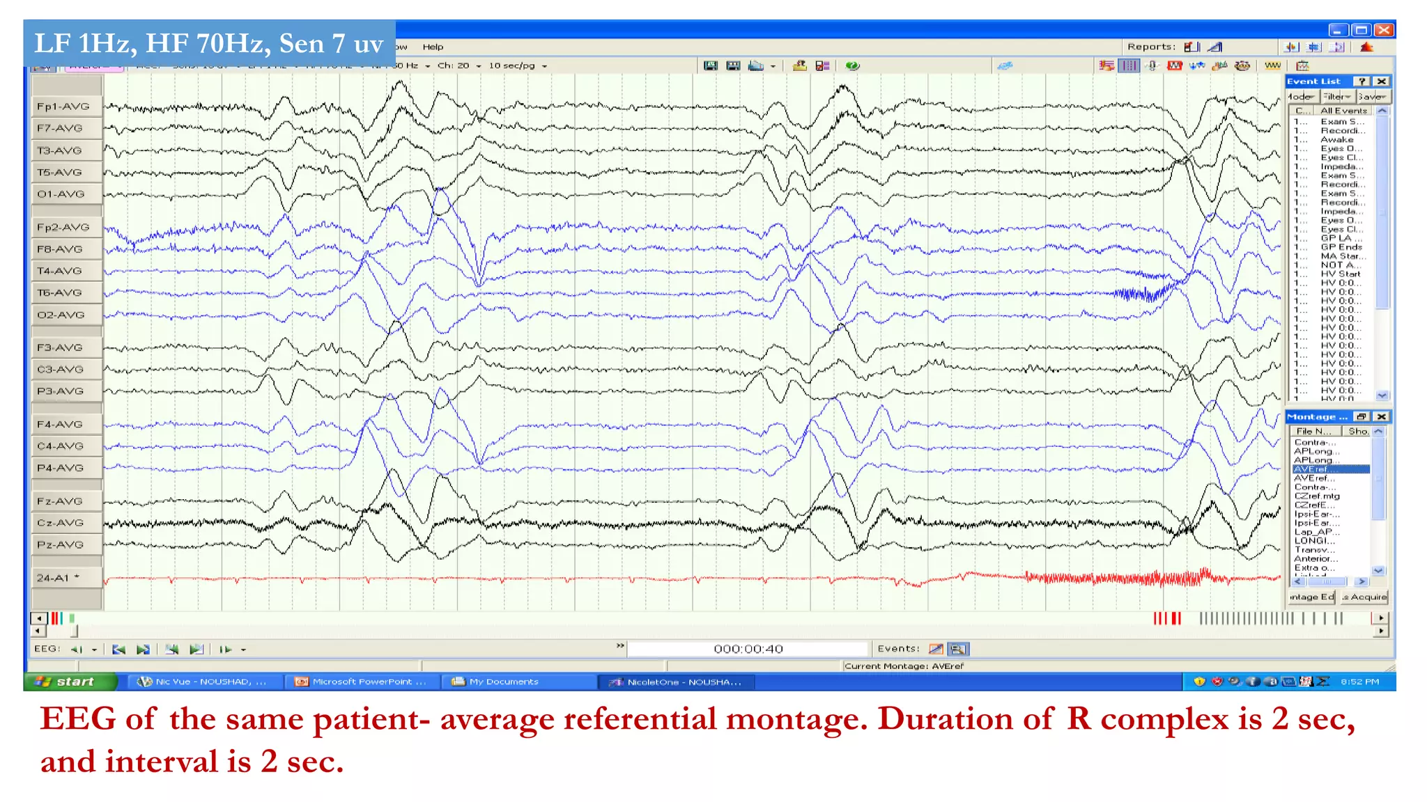 Generalised periodic epileptiform discharges | PPTX