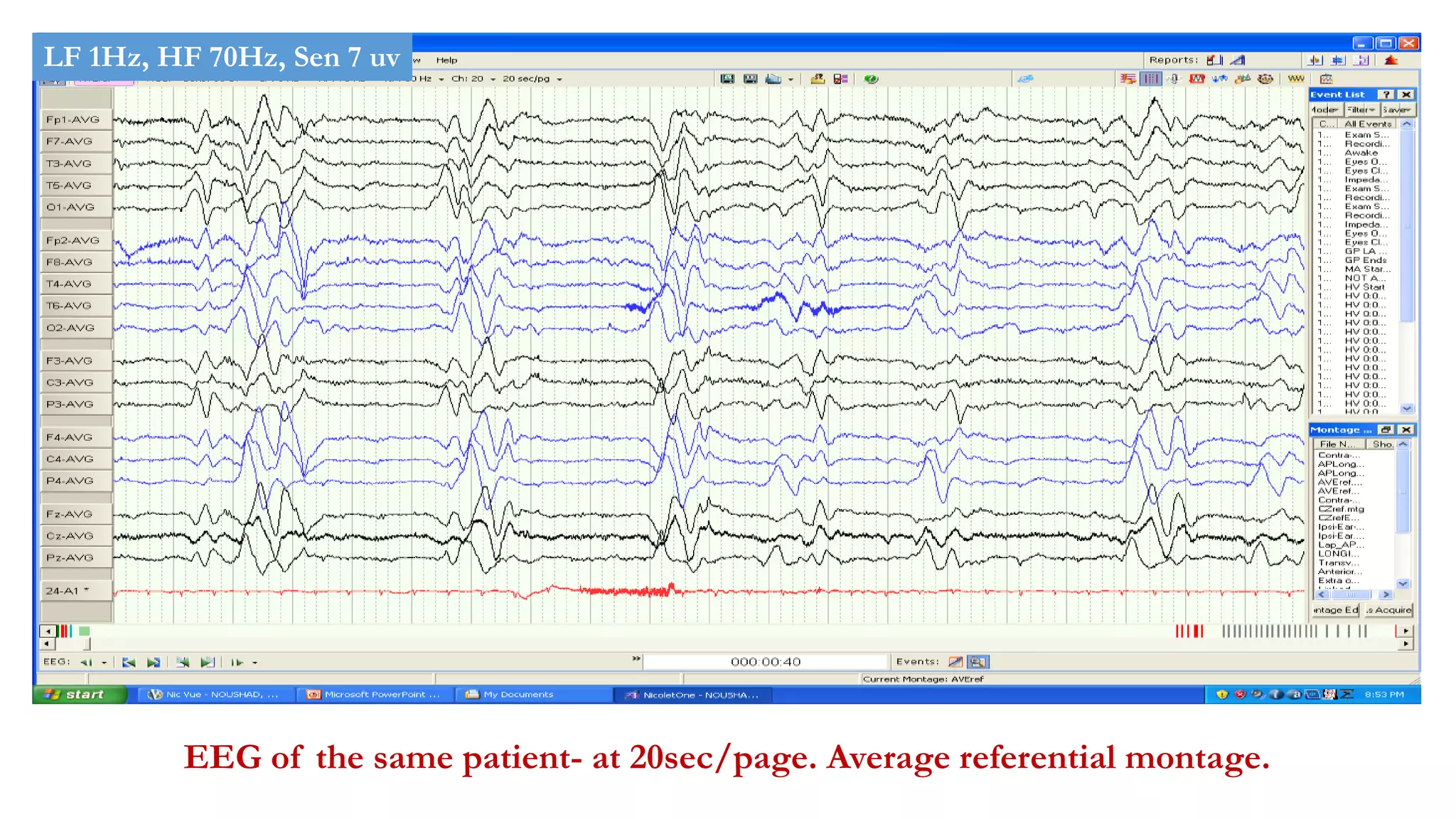 Generalised periodic epileptiform discharges | PPTX