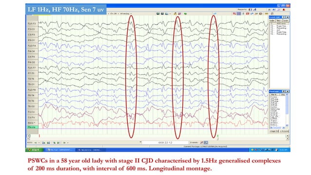 Generalised periodic epileptiform discharges | PPTX