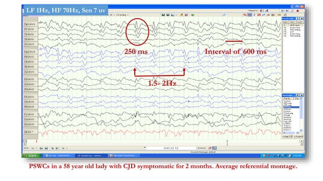 Generalised periodic epileptiform discharges | PPTX
