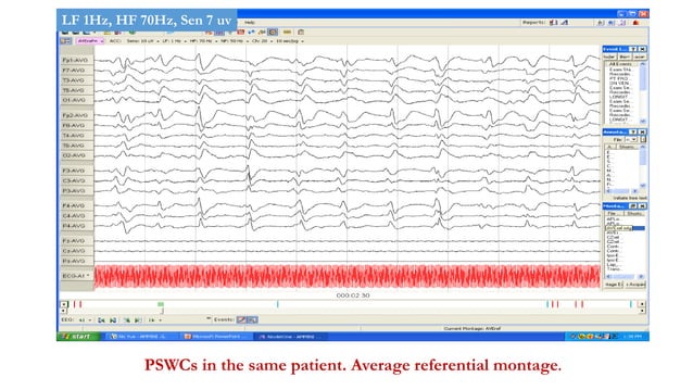 Generalised periodic epileptiform discharges | PPTX