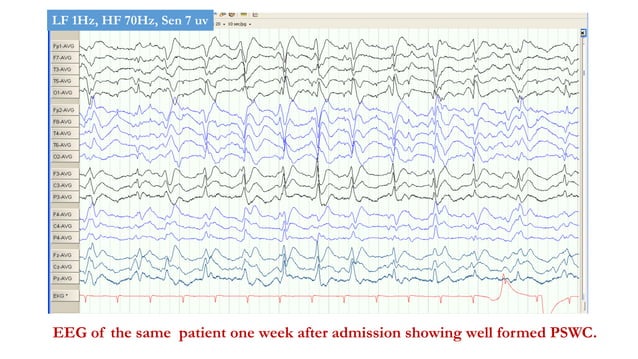 Generalised periodic epileptiform discharges | PPTX
