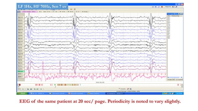 Generalised periodic epileptiform discharges | PPTX