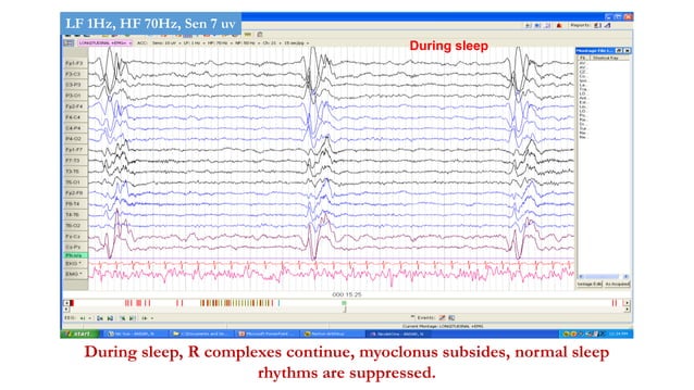Generalised periodic epileptiform discharges | PPTX