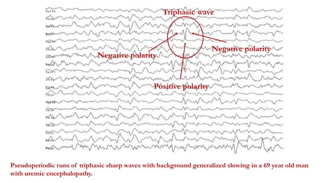 Generalised periodic epileptiform discharges | PPT