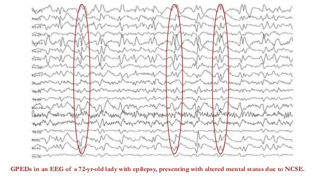 Generalised periodic epileptiform discharges
