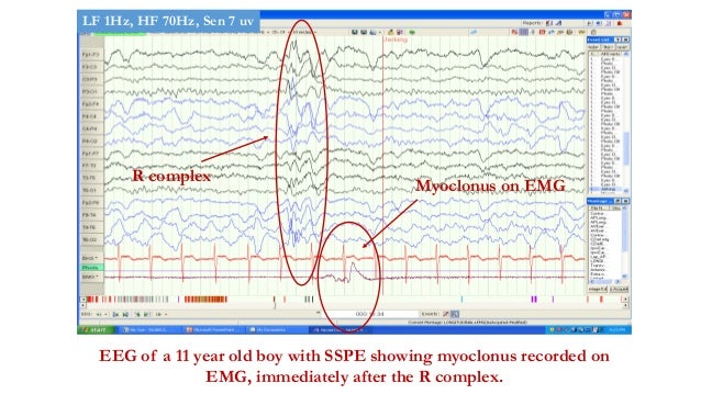 Generalised periodic epileptiform discharges