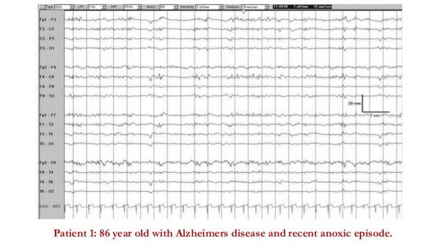 Periodic Epileptiform Discharges – FZPY