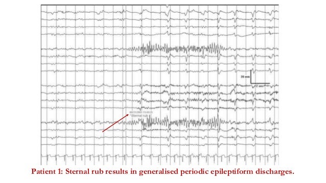 Generalised periodic epileptiform discharges