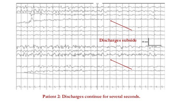 Generalised periodic epileptiform discharges