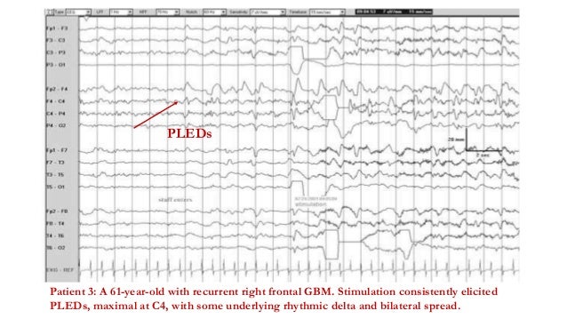 Generalised periodic epileptiform discharges