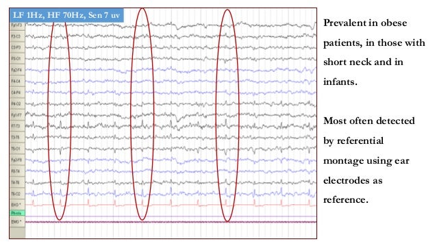 Generalised periodic epileptiform discharges