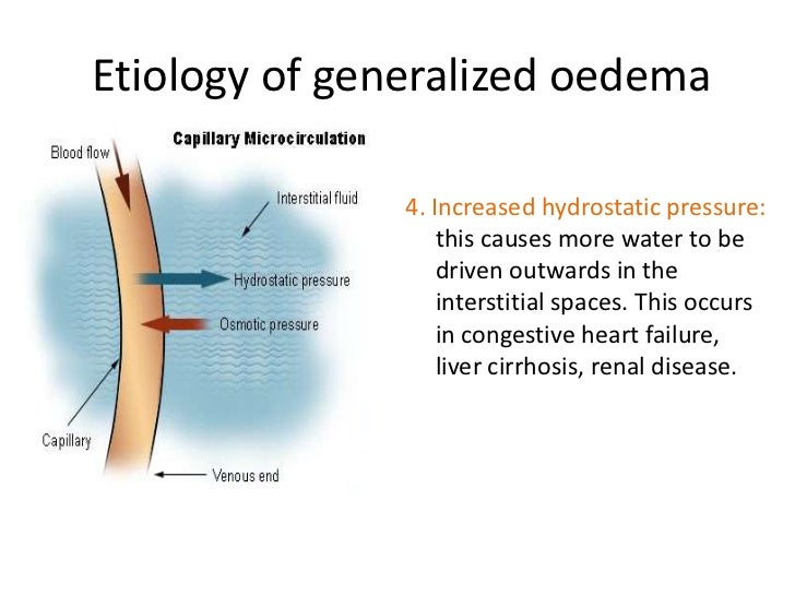 Generalized Edema Generalized And Localized Edema: A Clinical