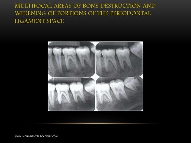 Generalized rarefaction of jaw bones /prosthodontic courses