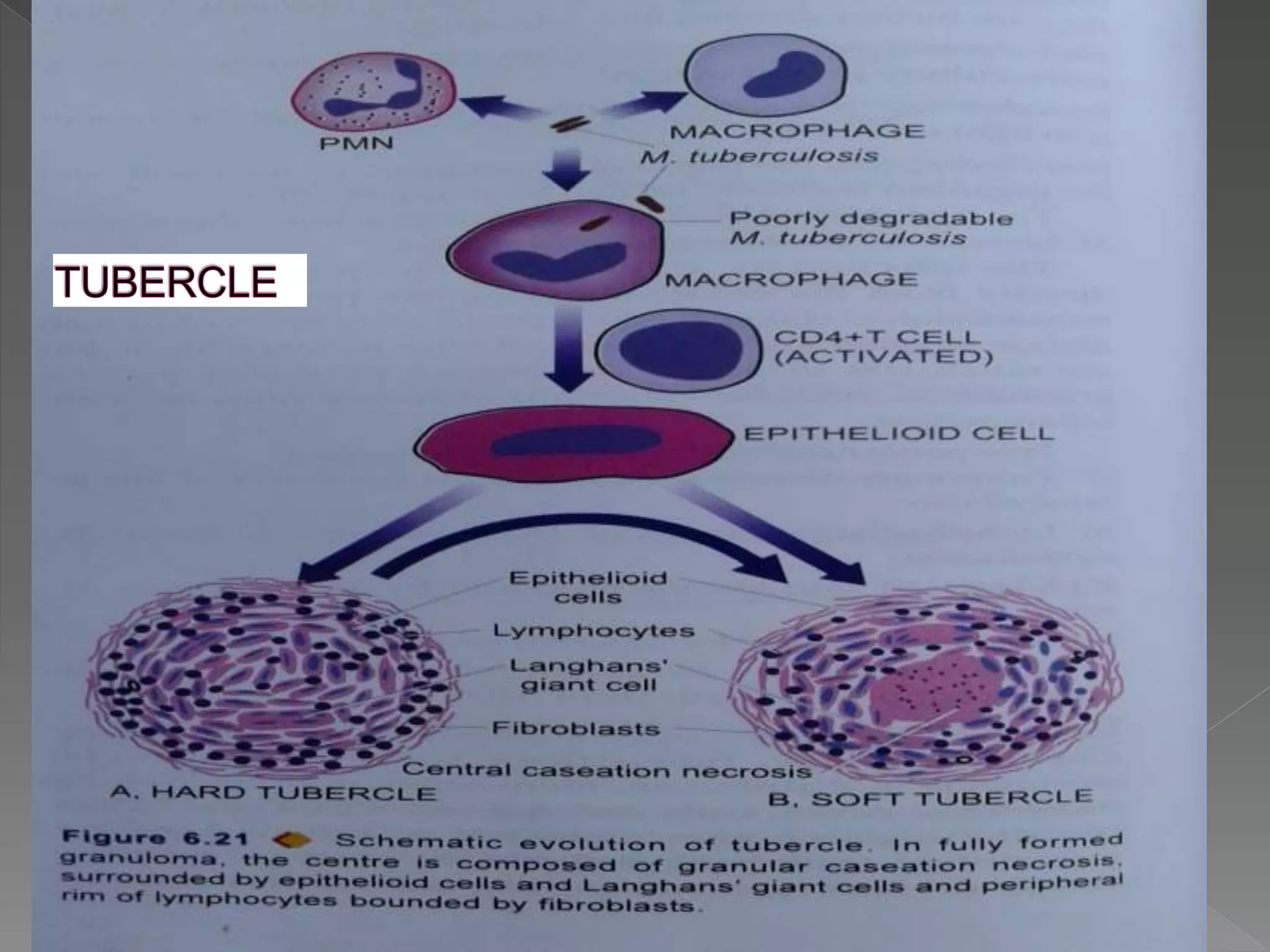 General outline of musculoskeletal tuberculosis by dr ashutosh | PPTX ...