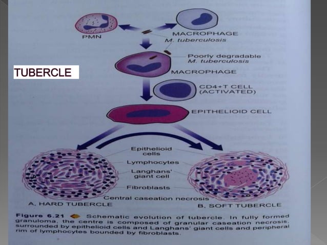 General outline of musculoskeletal tuberculosis by dr ashutosh | PPT
