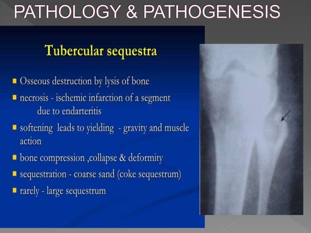 General outline of musculoskeletal tuberculosis by dr ashutosh | PPT