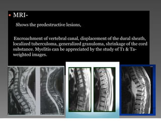 General outline of musculoskeletal tuberculosis by dr ashutosh | PPTX