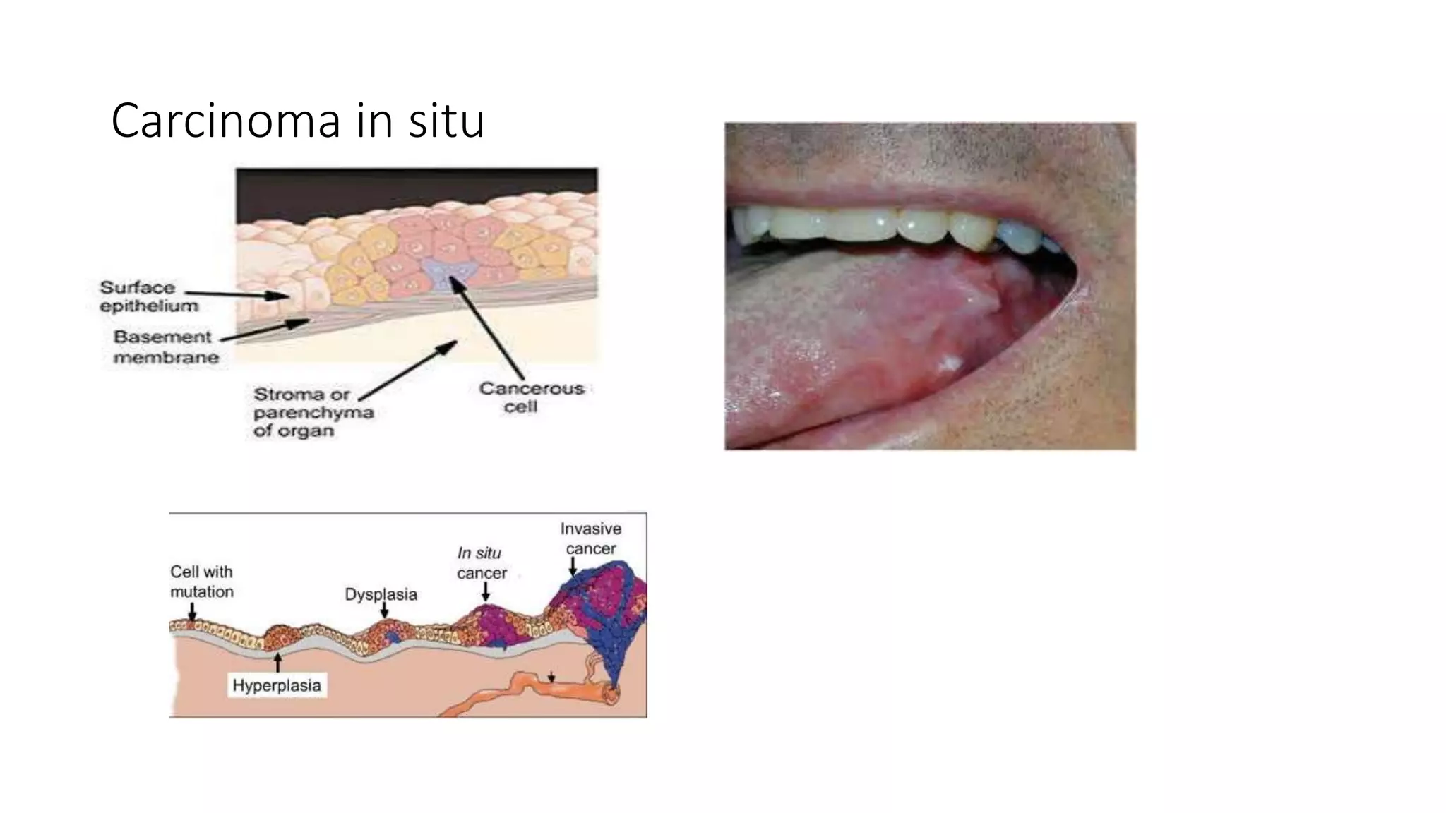 General overview of head and neck cancers | PPTX | Ear, Nose and Throat ...