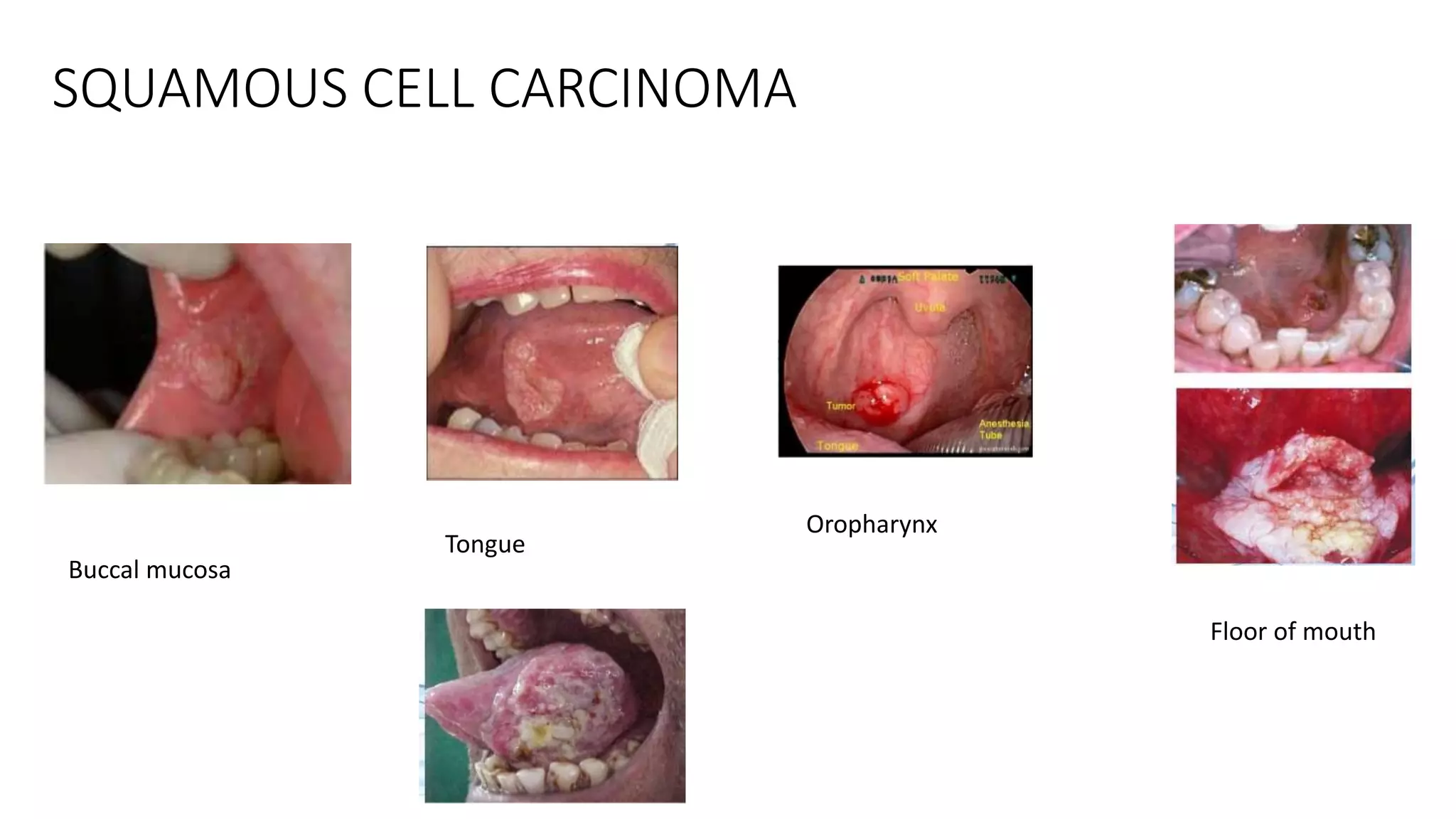 General overview of head and neck cancers | PPTX | Ear, Nose and Throat ...