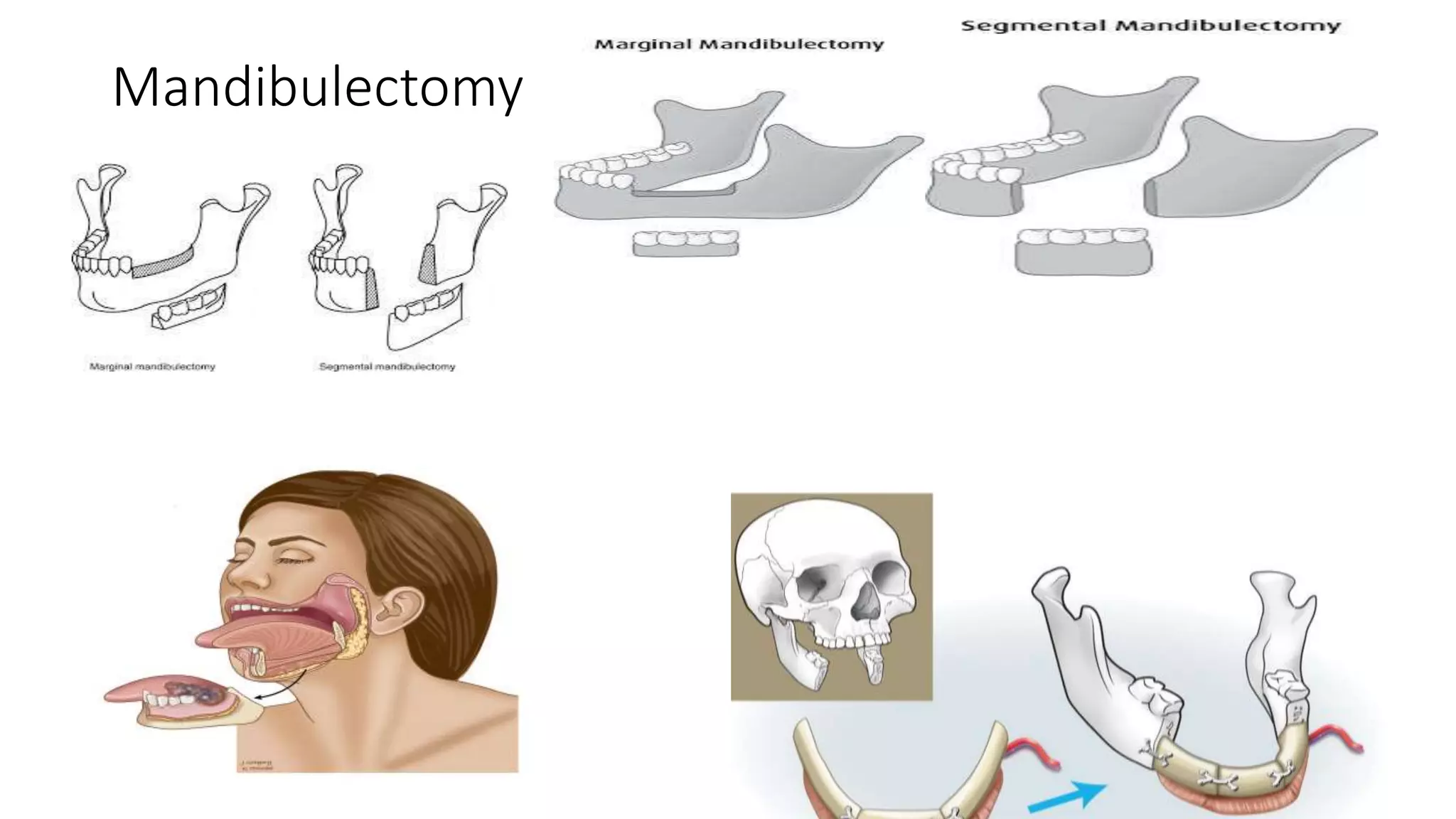 General overview of head and neck cancers | PPTX | Ear, Nose and Throat ...