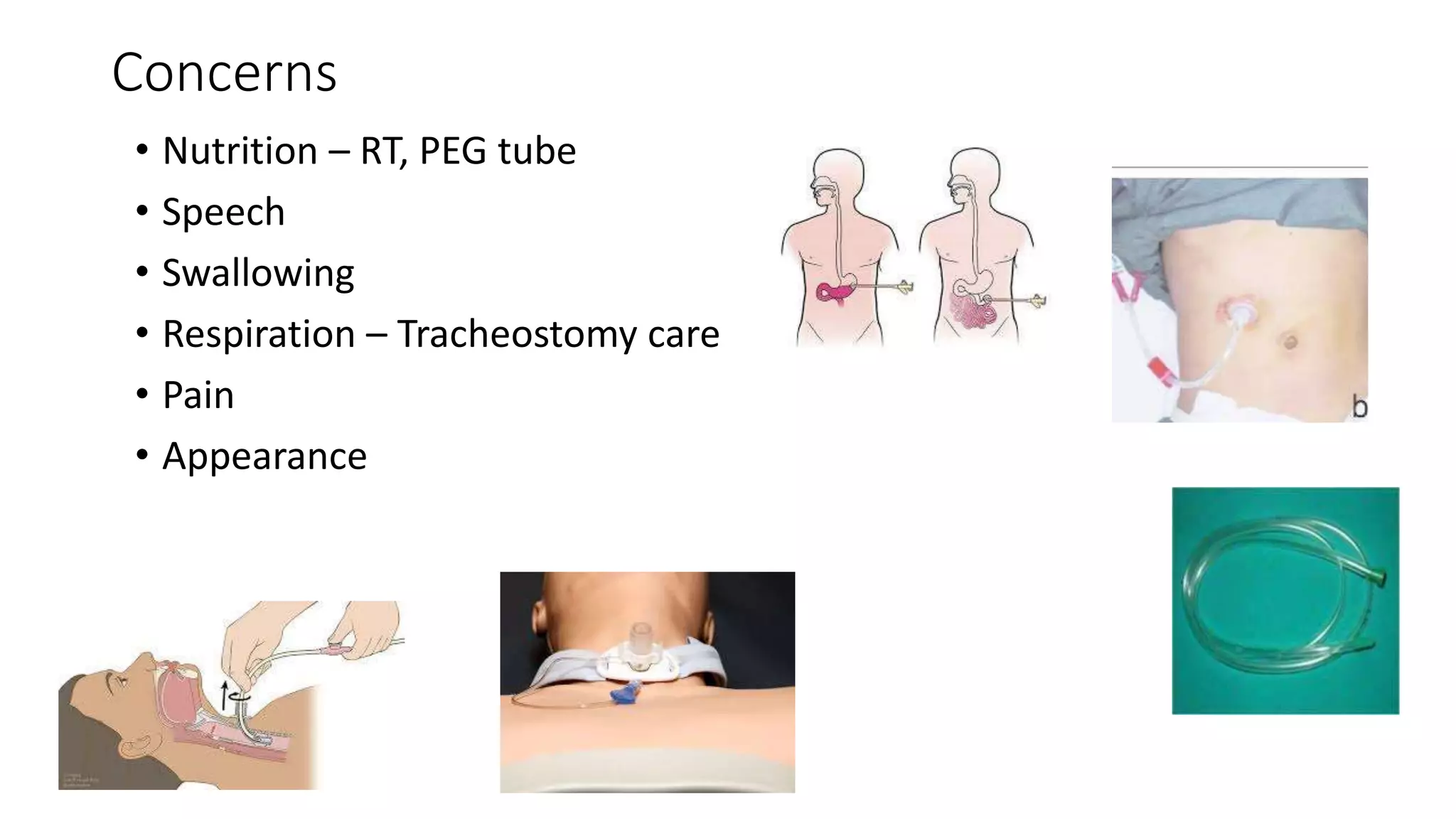General overview of head and neck cancers | PPTX | Ear, Nose and Throat ...