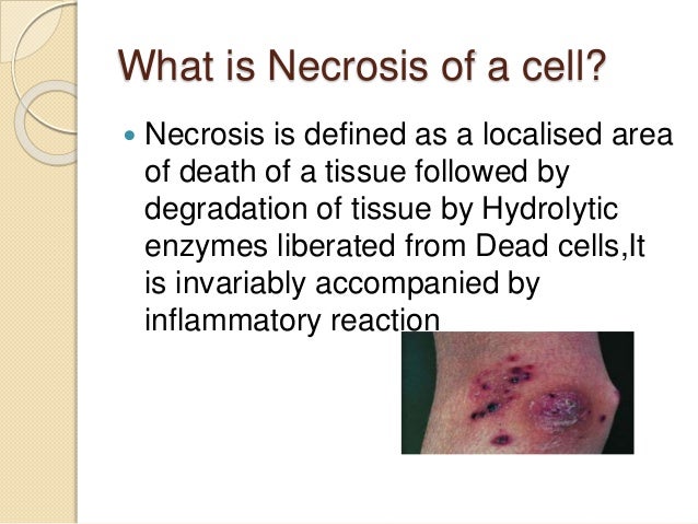 General pathology necrosis