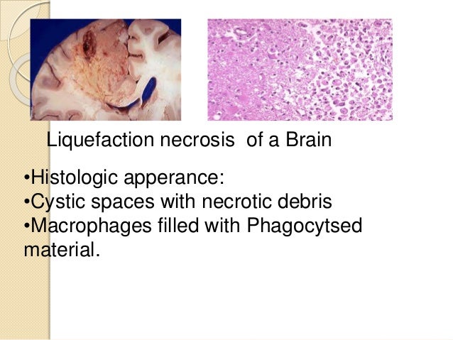 General pathology necrosis