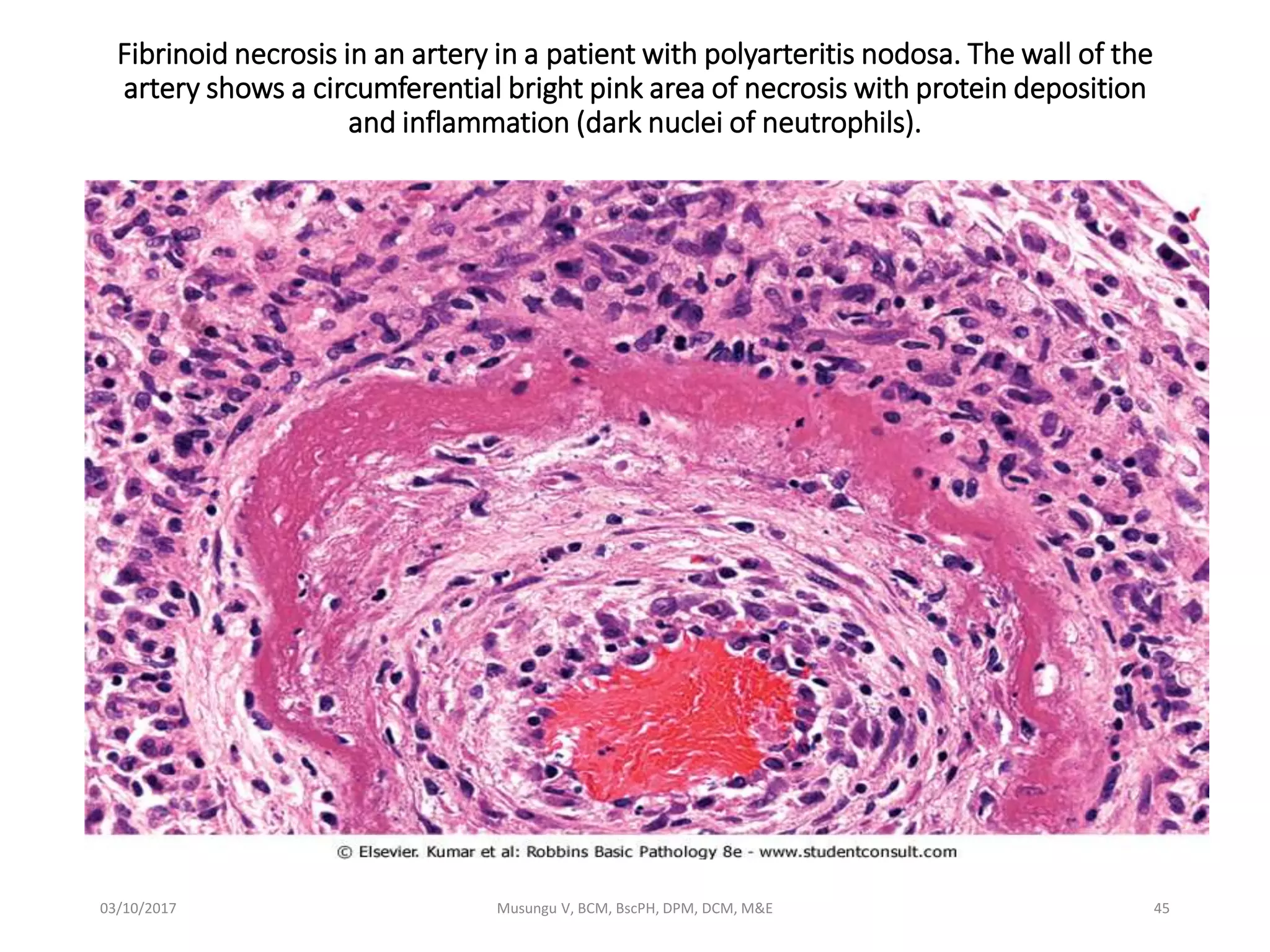 General pathology lecture | PPTX | Heart and Cardiovascular Diseases ...
