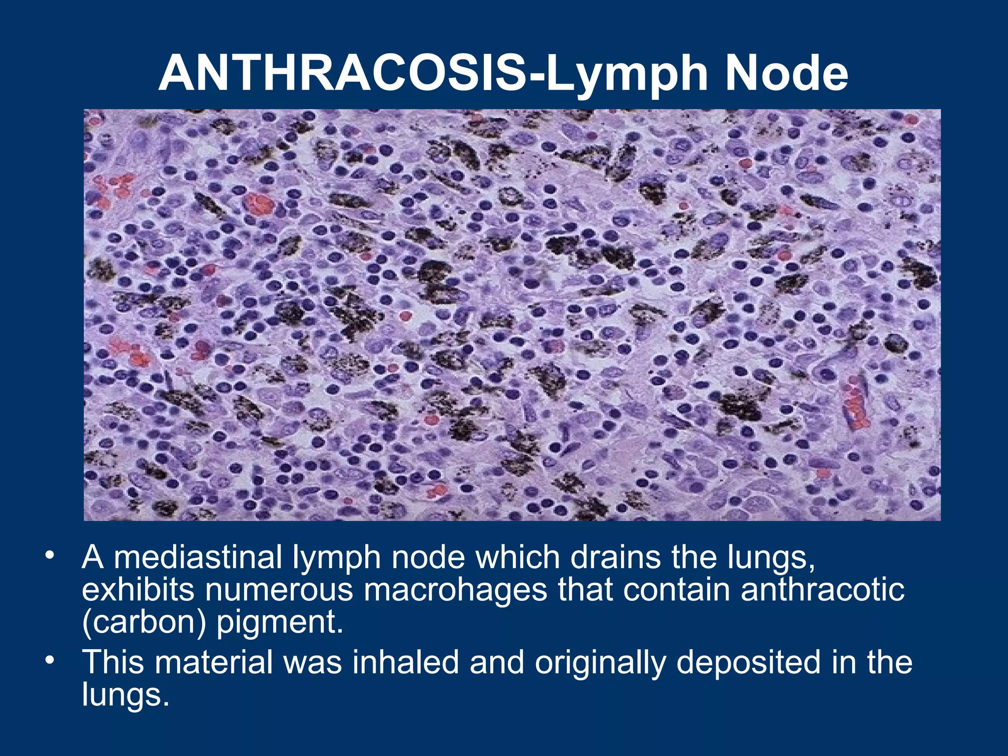 General pathology lecture 2 intracellular accumulations | PPT