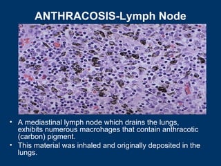 General pathology lecture 2 intracellular accumulations | PPT