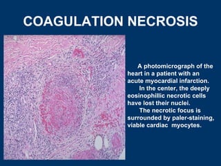 General pathology lecture 3 cell death or necrosis | PPT