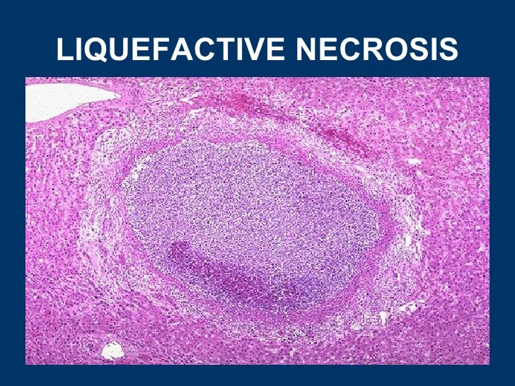 General pathology lecture 3 cell death or necrosis