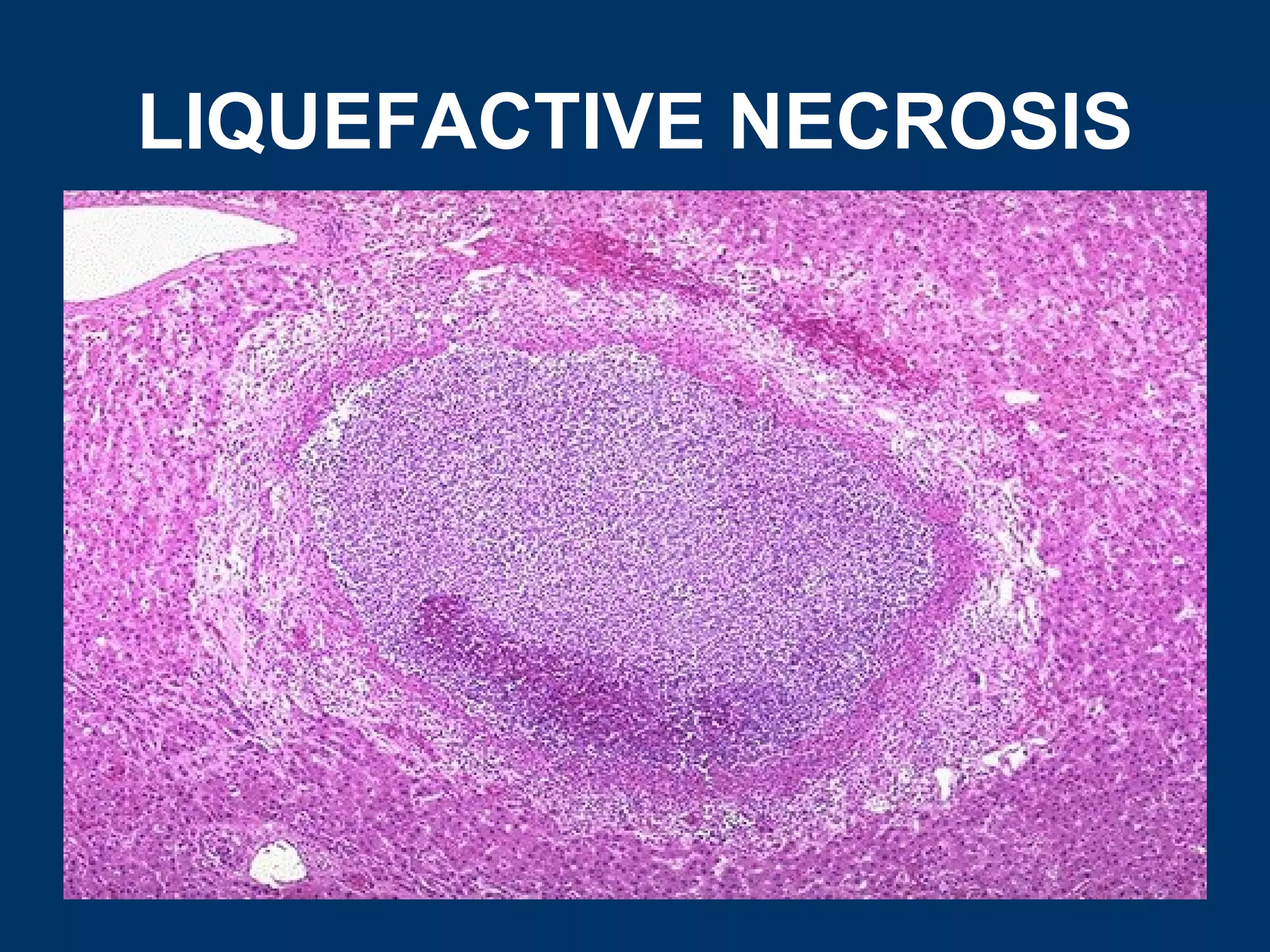 General pathology lecture 3 cell death or necrosis | PPT