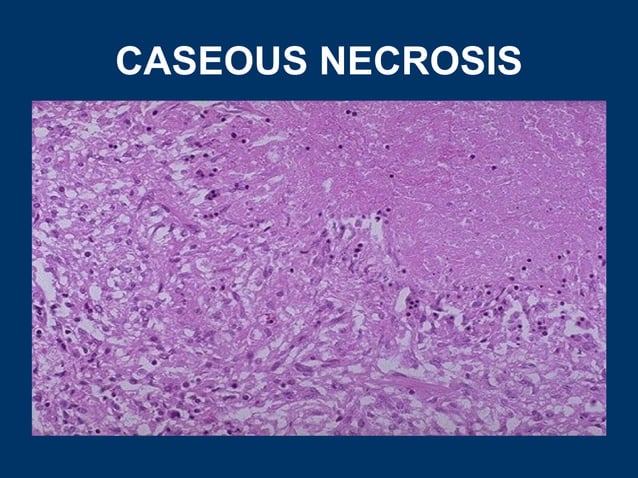 General pathology lecture 3 cell death or necrosis | PPT