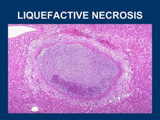 General pathology lecture 3 cell death or necrosis | PPT