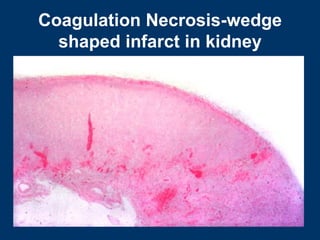 General pathology lecture 3 cell death or necrosis | PPT