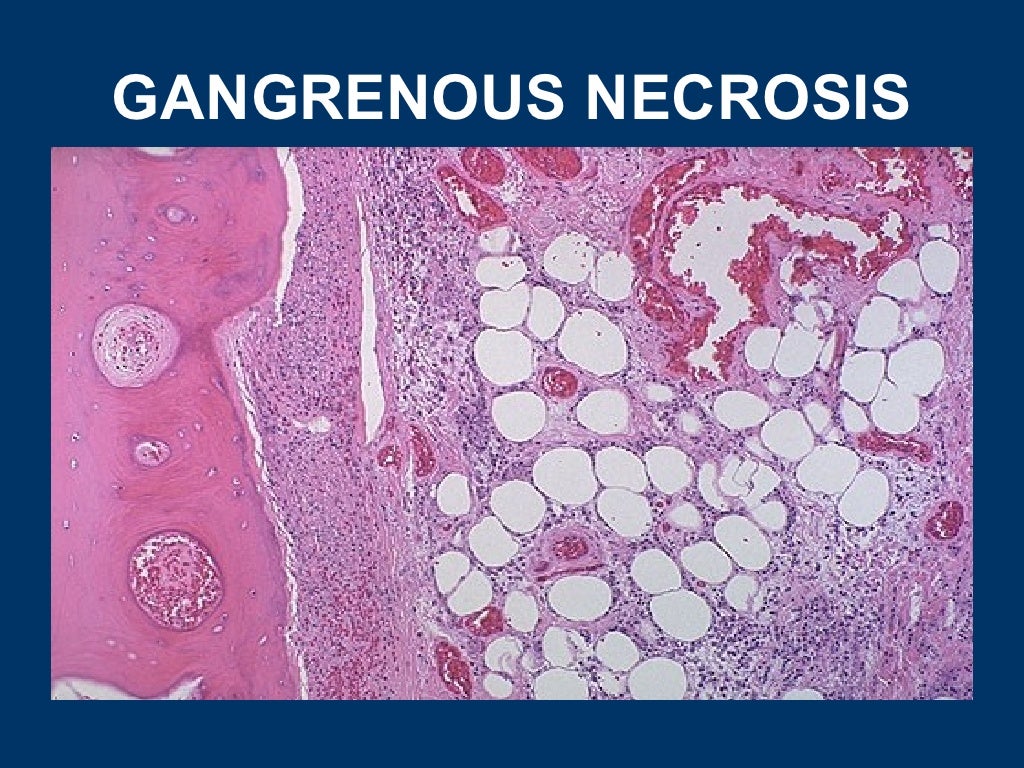 General pathology lecture 3 cell death or necrosis