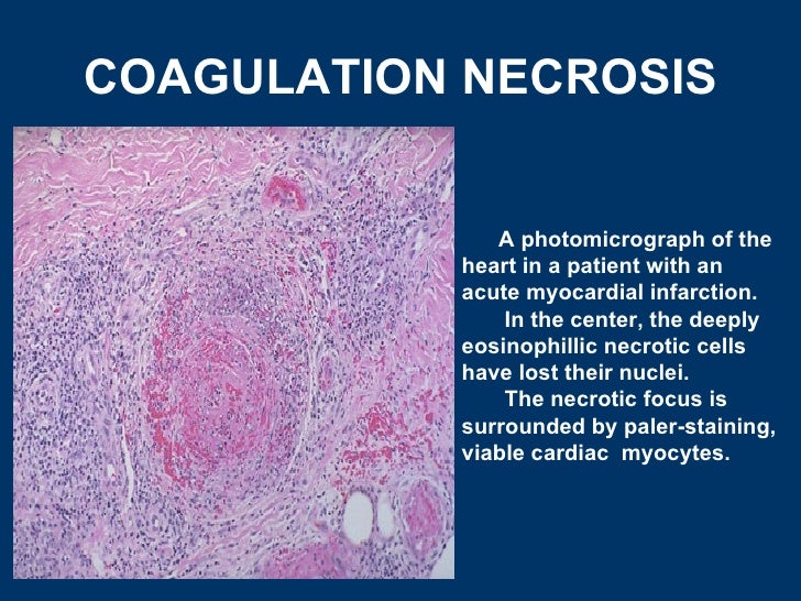 General pathology lecture 3 cell death or necrosis