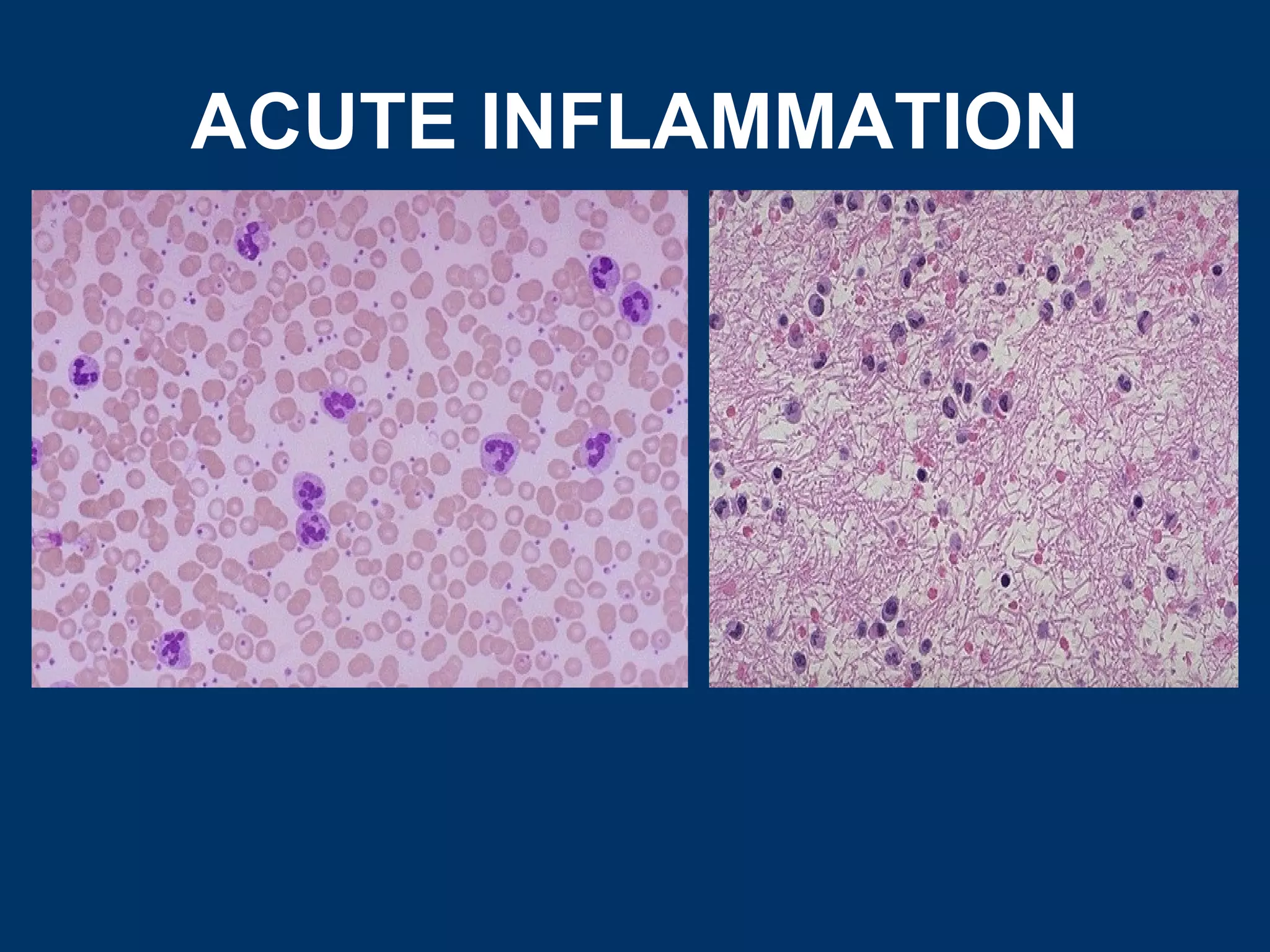 General pathology lecture 5 inflammation & repair | PPT
