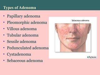 General pathology lecture 6 adenoma | PPT