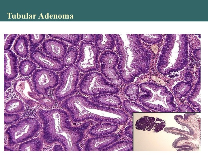 General pathology lecture 6 adenoma