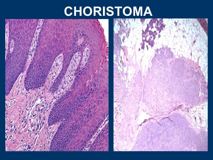 General pathology lecture 7 neoplasms