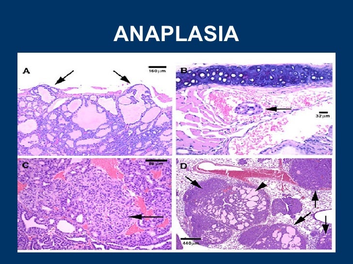 General pathology lecture 7 neoplasms
