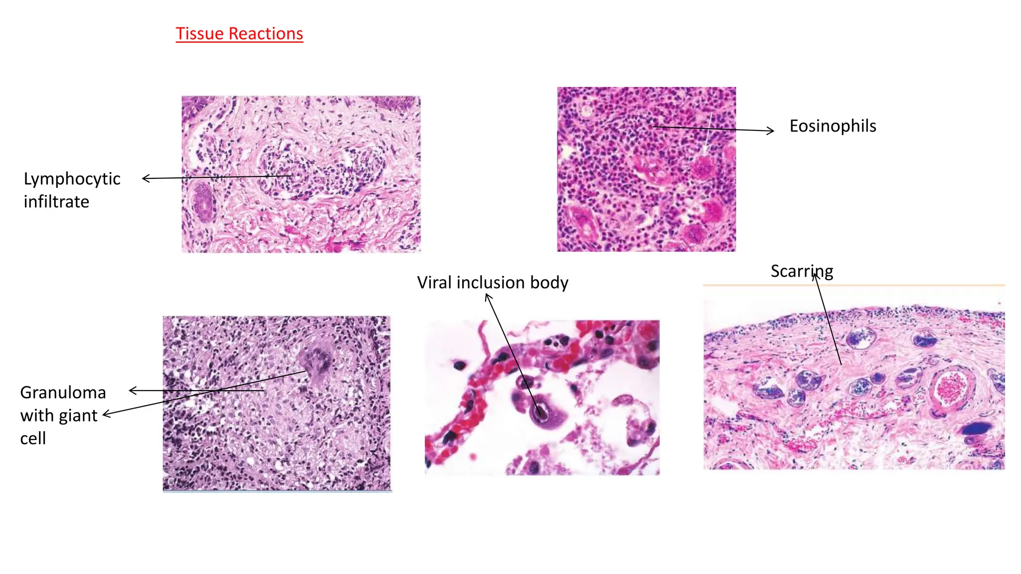 General Pathology of Infections and Acute Bacterial Infections 23_5_23.pptx