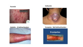 General Pathology of Infections and Acute Bacterial Infections 23_5_23 ...