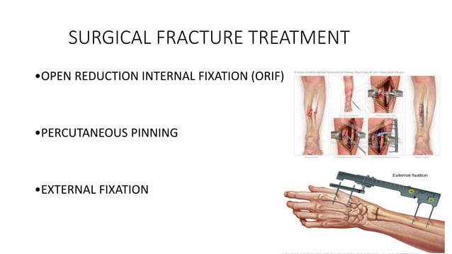 GENERAL_PRINCIPLES_OF_FRACTURE_MANAGEMENT.ppt