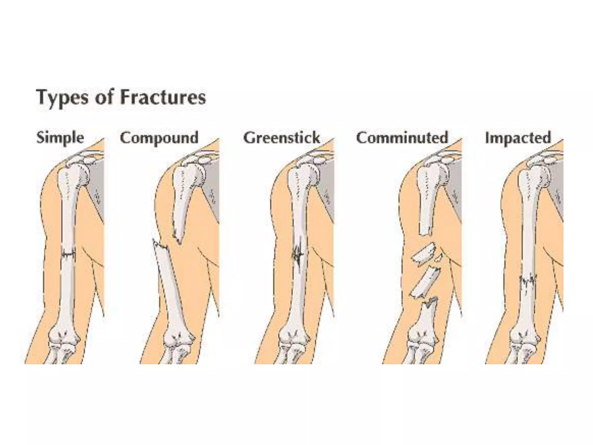 General principles of fractures | PPTX