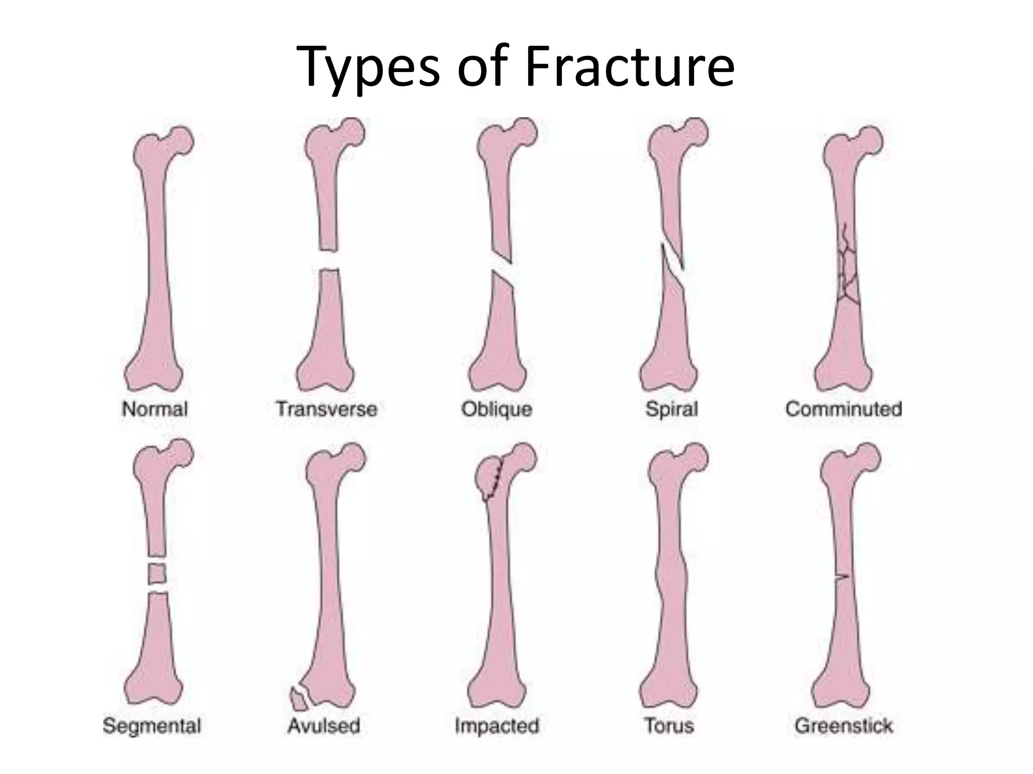 General principles of fractures | PPTX